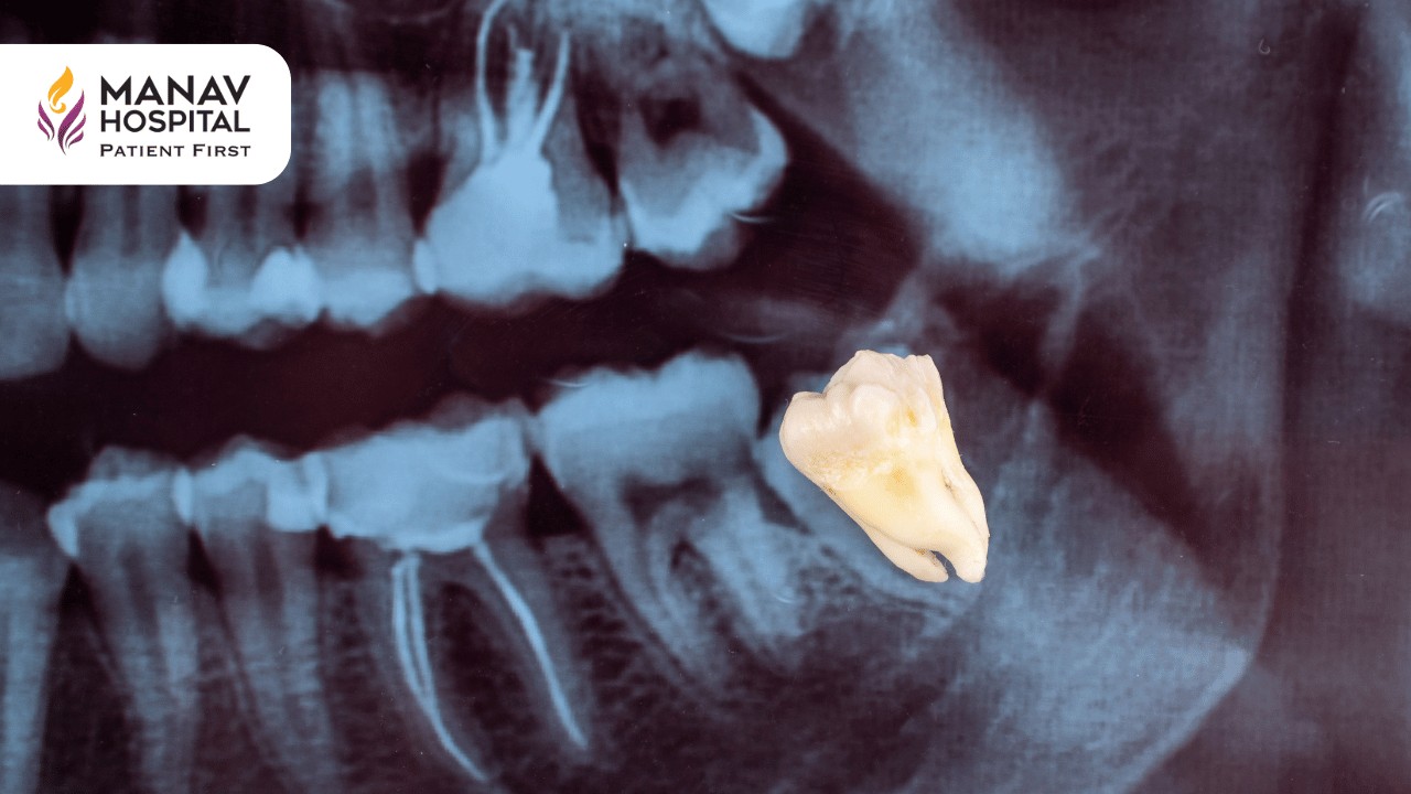 Best Wisdom Tooth Extraction Hospital in Ghaziabad
